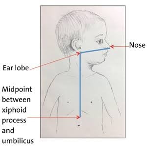 The Hidden Risk of Neonatal Growth In Tube Placement - Case Study